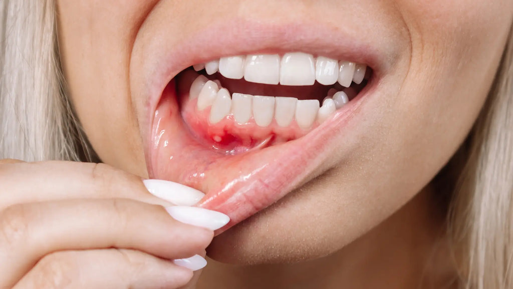 Holistic Remedies for Receding Gums: Can Natural Treatments Help? – Keeko